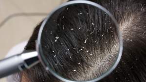 Does dandruff cause acne? Exploring the Myths and Facts - Dermijan skin ...